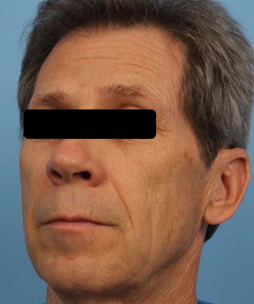 Tratamente laser eCO2 Lutronic - Dermaspa - Ana Maria Nedelcu